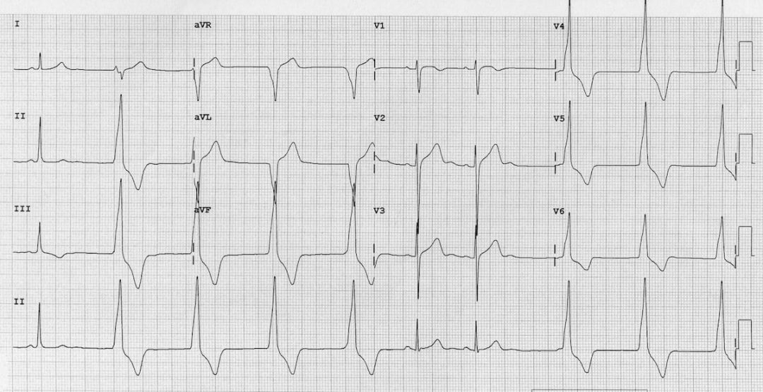 Accelerated-Idioventricular-Rhythm-AIVR-ECG-1 | IACS
